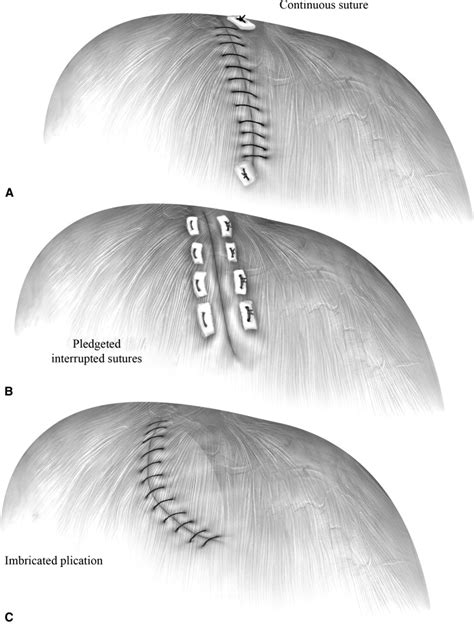 Technique Of Video Assisted Thoracoscopic Surgery Diaphragm Plication