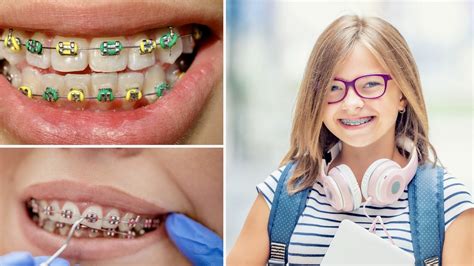 Brackets Esteticos Tipos At Cristy Fields Blog