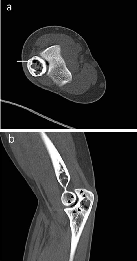 Axial A And Sagittal B Ct Scan Revealed Intralesional Gas White