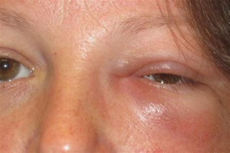 What Is Dacryocystitis Symptoms Causes And More The Eye News