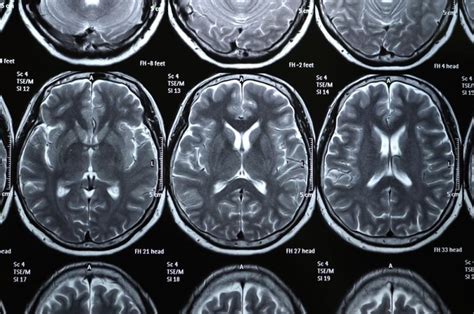 Brain Scans Predict Ocd Patients Fit For Specific Treatment