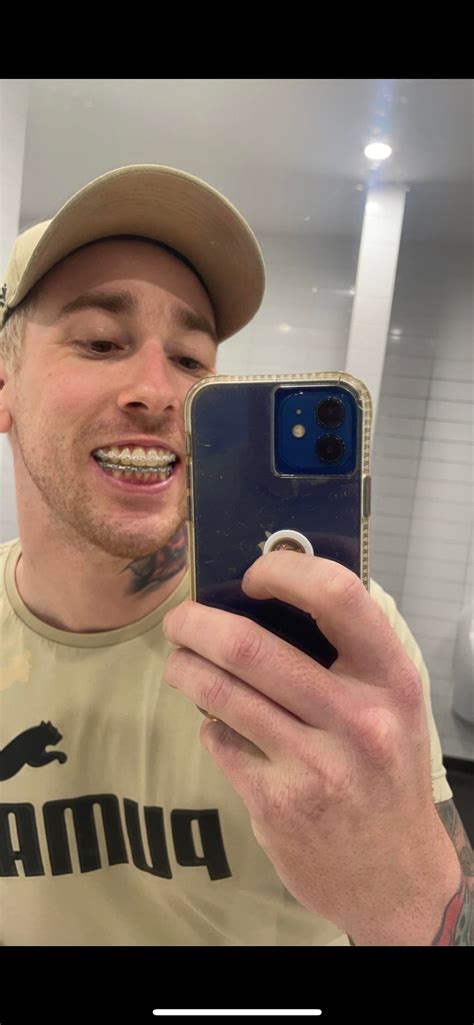 First Time Getting Mini Screws R Braces