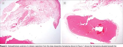 Figure 1 From Deep Dissecting Hematoma An Emerging Severe Complication