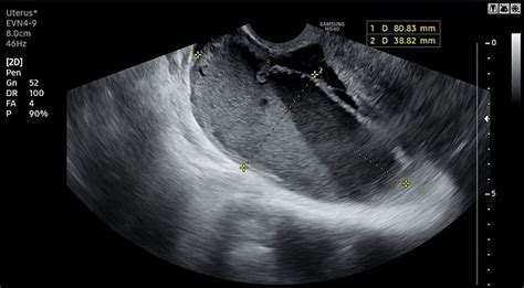 Pelvic Inflammatory Disease Article Glowm