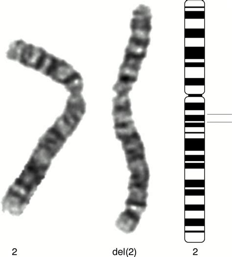 A Transmitted Deletion Of 2q13 To 2q14 1 Causes No Phenotypic