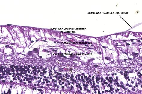 Membrana Hialoidea Posterior Ocularpat