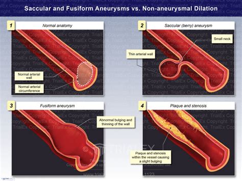Saccular And Fusiform Aneurysms Vs Non Aneurysmal Dilation Tri