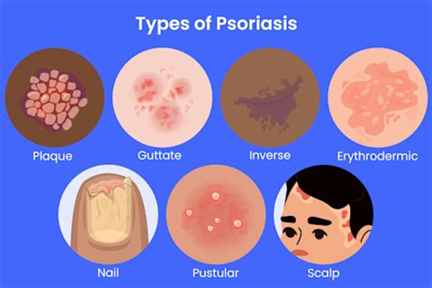 Types Of Psoriasis Pictures Symptoms And Treatments