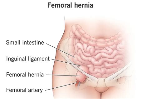 Understanding The Types Of Hernia