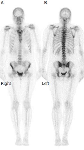 Normal Bone Scan