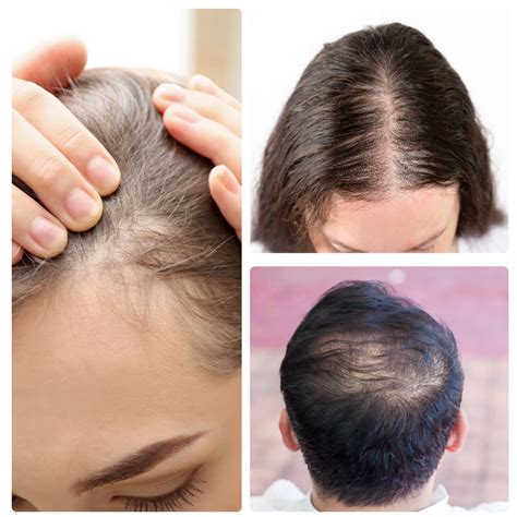 Hair Loss Treatments Dermondemand