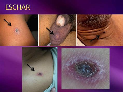 Scrub Typhus 2018 Final Pptx