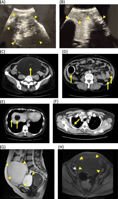 Figure 1 From Mature Ovarian Cystic Teratoma With Disseminated Nodular
