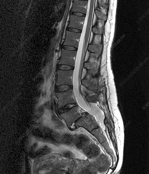 Spondylolysis Mri
