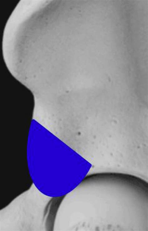 Arthroscopic Decompression Of A Type Iii Subspine Impingement Pmc