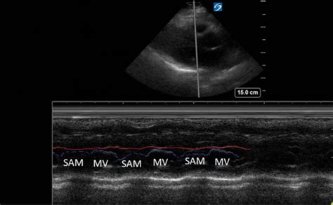 Motion Of The Hocean A Clinical Case Of Hypertrophic Obstructive