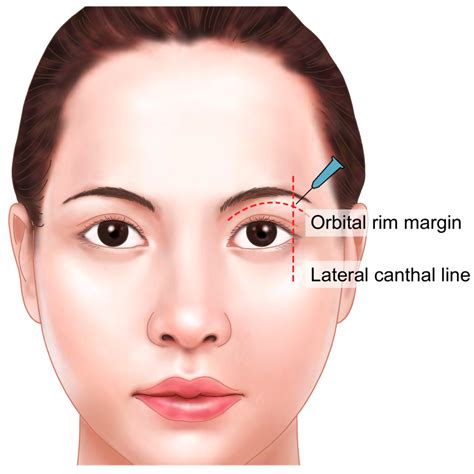 Anatomy Based Filler Injection Treatment Techniques For Supraorbital