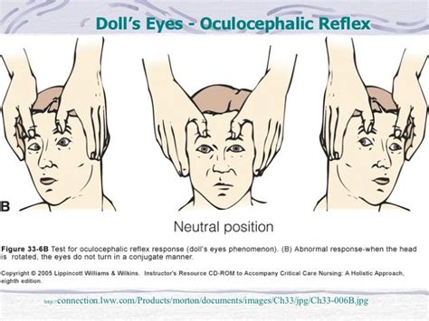 Nurserevieworg Nursing Management Of The Adult Client With Neurolo