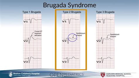 Brugada Syndrome Type 3