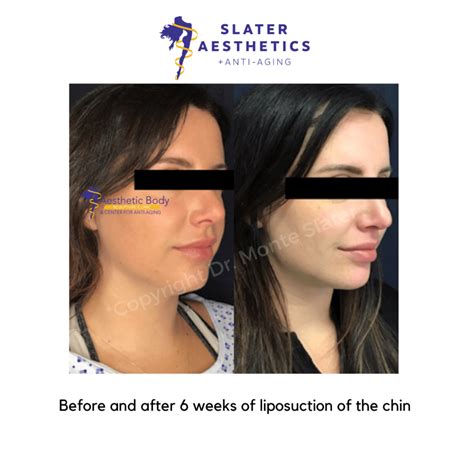 Top Liposuction Results By Dr Monte Slater Atlanta And Warner Robins
