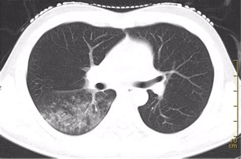 肺部 Ct ：快速识别各类影像病变