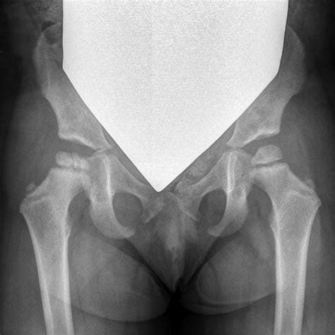 Meyer Dysplasia Not To Be Mistaken For Legg Calve Perthes Disease Delay In Development Of