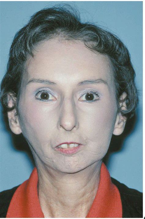 Systemic Sclerosis Medizzy