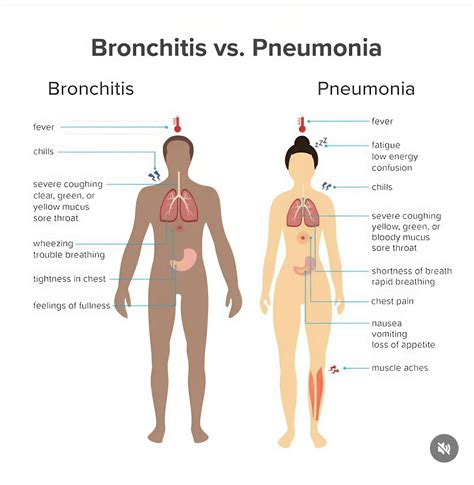 Dr Muhammed Differences Between Bronchitis And Pneumonia Bronchitis