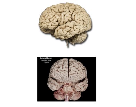 Brain Cadaver Anterior And Lateral View Quiz