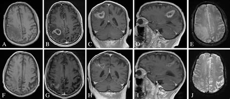 Mri Of The Brain Pre And Post Corticosteroid Therapy A Initial