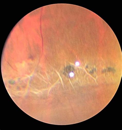 Lattice Degeneration Of The Retina Retina Center Of San Diego