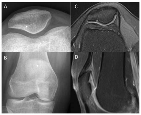 Lucent Patellar Lesions A Pictorial Review Pmc