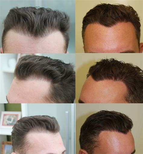 Comparison Density Hair Transplant 35 Vs 60 Grafts Hairforlife
