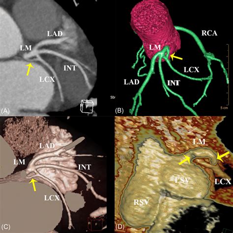 A The Maximum Intensity Projection Coronary Computed Tomography