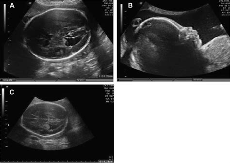 Macrocephaly Ultrasound