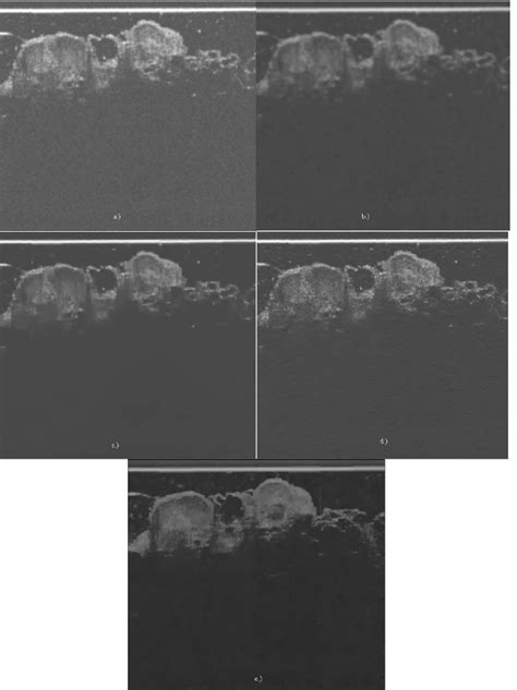 Oct Image Of The Breast Cancer Denoised Using A Rotating Kernel