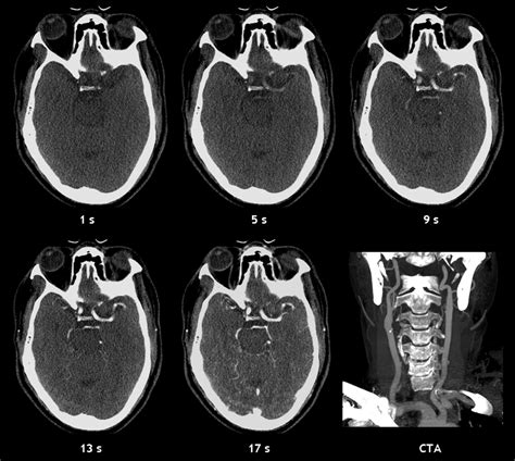 Responses To The 10 Most Frequently Asked Questions About Perfusion Ct Ajr