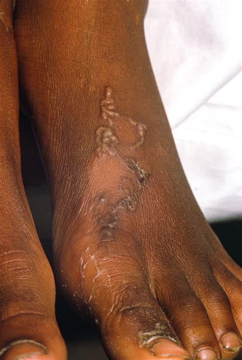 Hookworm Infection Infectious Diseases Msd Manual Professional Edition