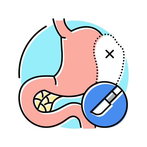 Splenectomy Surgery Hospital Color Icon Illustration 52844119 Vector Art At Vecteezy