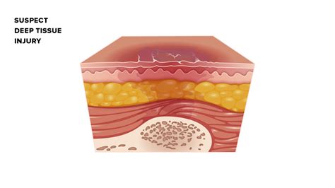 Pressure Ulcer Staging Guide