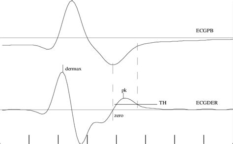 Determination Of The End Of The Qrs By The Threshold Method Download