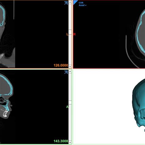 Steps Involved In The Creation Of An Experimental Segmental Defect