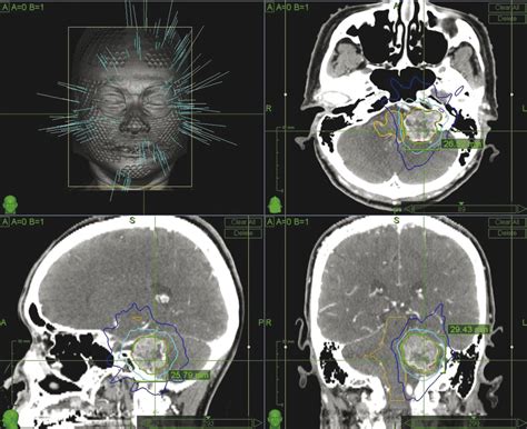 19 Cyberknife Radiotherapy For Treatment Of Sporadic Vestibular Schwannoma Neupsy Key