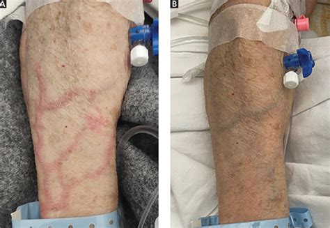 Acute Transient Phlebitis After A Morphine Infusion Cleveland Clinic