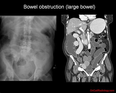 On Call Radiology Common Radiology Findings On Call And In The
