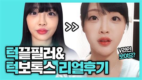 턱끝필러로 달덩이🌝에서 계란형 얼굴🥚 만든다면 L 굿닥몬이 간다 Youtube