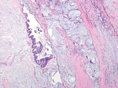 Metastatic Tumors To The Ovary Including Hematolymphoid Neoplasms And