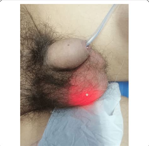 Positive Transillumination Test For The Right Hemiscrotum Right