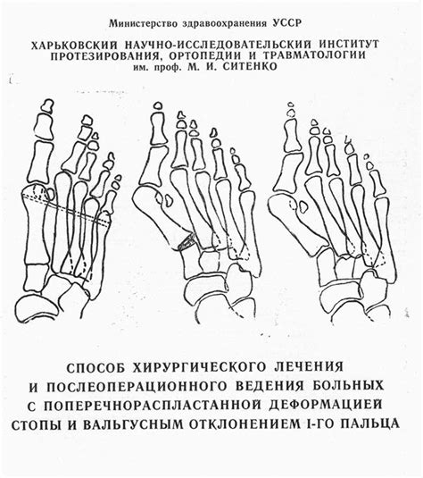 Косточка на большом пальце ноги Tezska1 — Livejournal