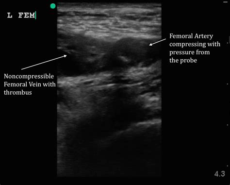Popliteal Vein Ultrasound